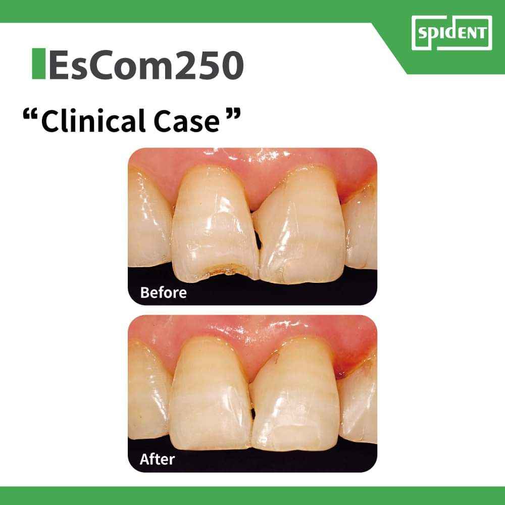 Spident EsCom250 NanoHybrid Composite System Kit